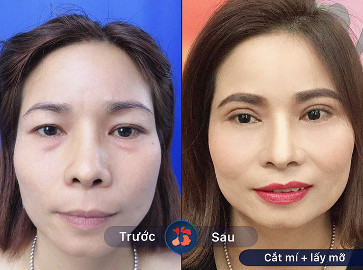 Album khách hàng Thẩm mỹ mắt