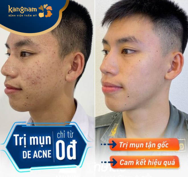Địa chỉ trị mụn ở Đà Nẵng: Uy Tín, Hiệu Quả