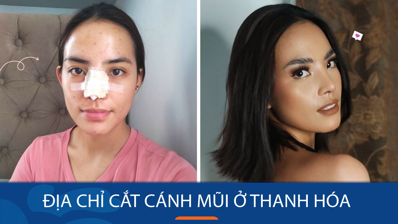 Cắt cánh mũi kangnam Thanh Hóa - Mũi thon gọn, đẹp tự nhiên