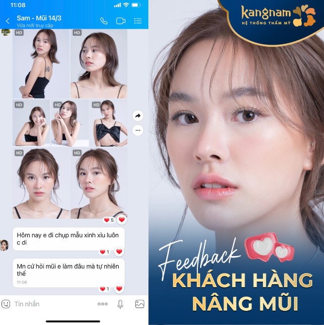 nâng mũi kangnam Cần Thơ mang lại dáng mũi cao