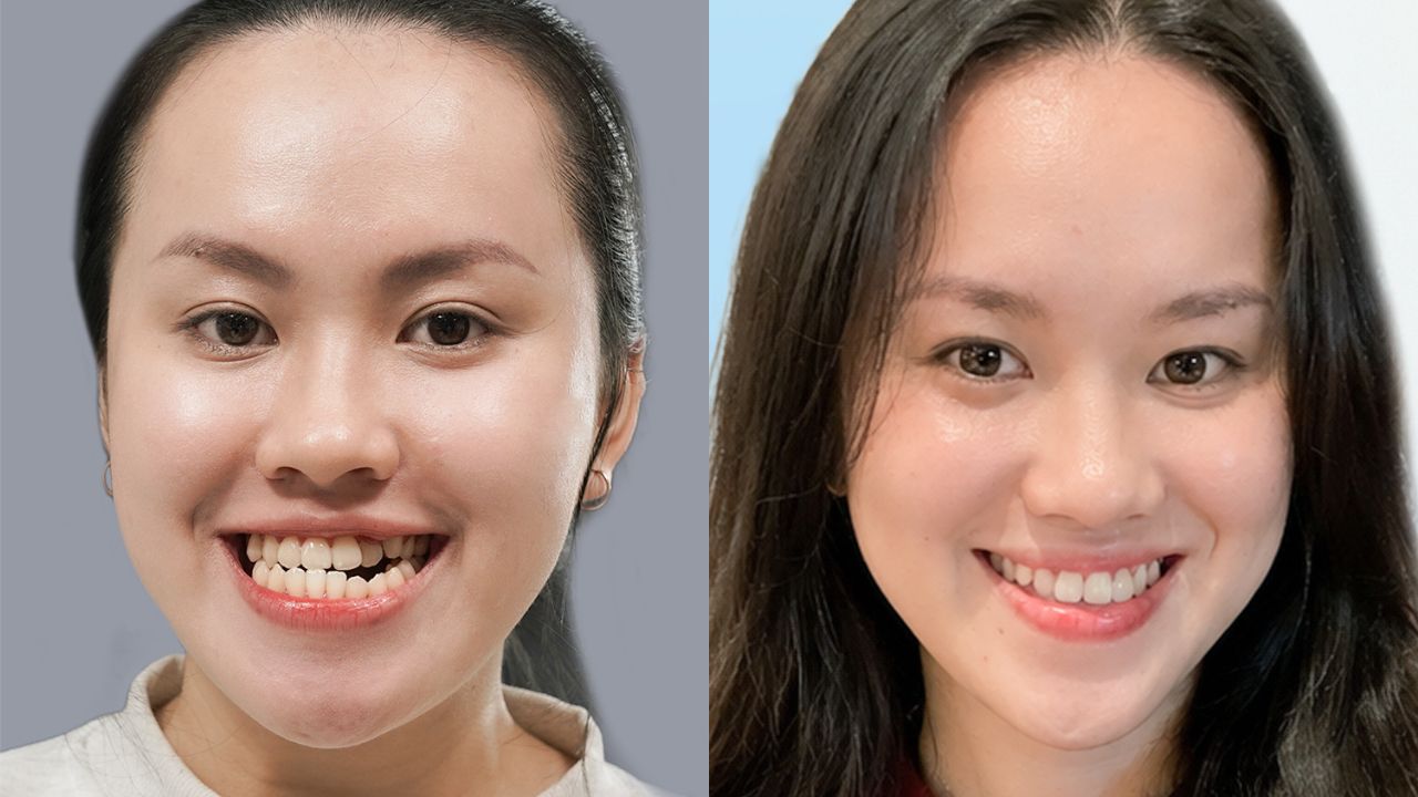 Thay đổi diện mạo sau 30 ngày chỉnh hàm móm của cô lễ tân Phương Quyên